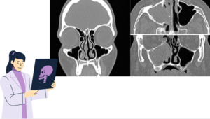 Chronic Sinusitis CT Scan | 2 Safety Issue | World Health