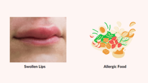 Swollen Lips Allergy Food | Causes | 3 Best Home Treatment